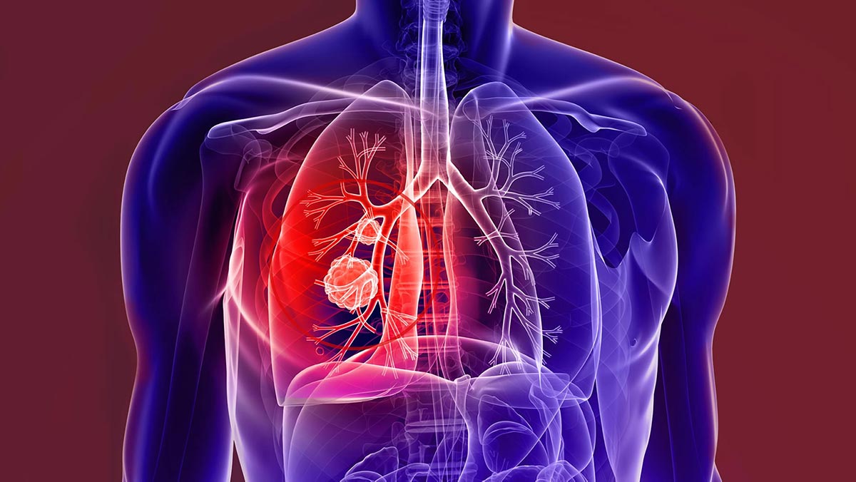 Prirodni lijek za bronhitis i astmu - Biljka koji čuva pluća (recept za ...