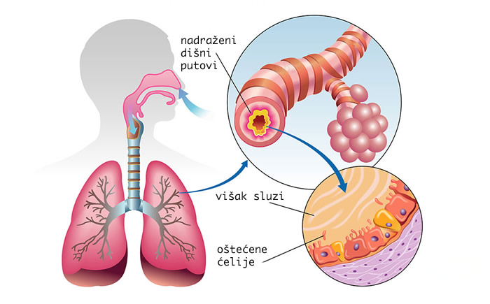 Bronhitis - Uzroci, simptomi, liječenje kod djece i odraslih
