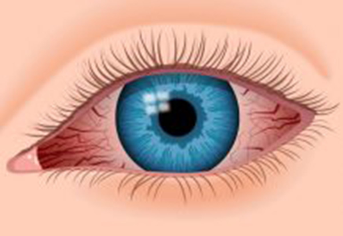 Crveno oko prirodni lijek - Najčešći uzroci crvenog oka