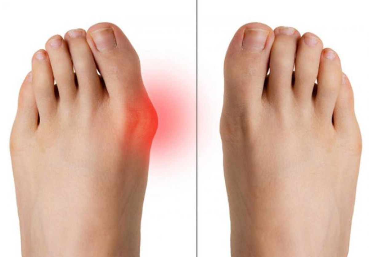 Čukljevi na nogama - Zašto nastaju i kako ih liječiti, koje vježbe raditi