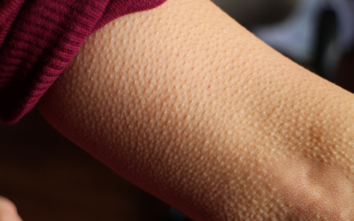 Gušćja koža: uzroci, prevencija i liječenje ove kožne bolesti