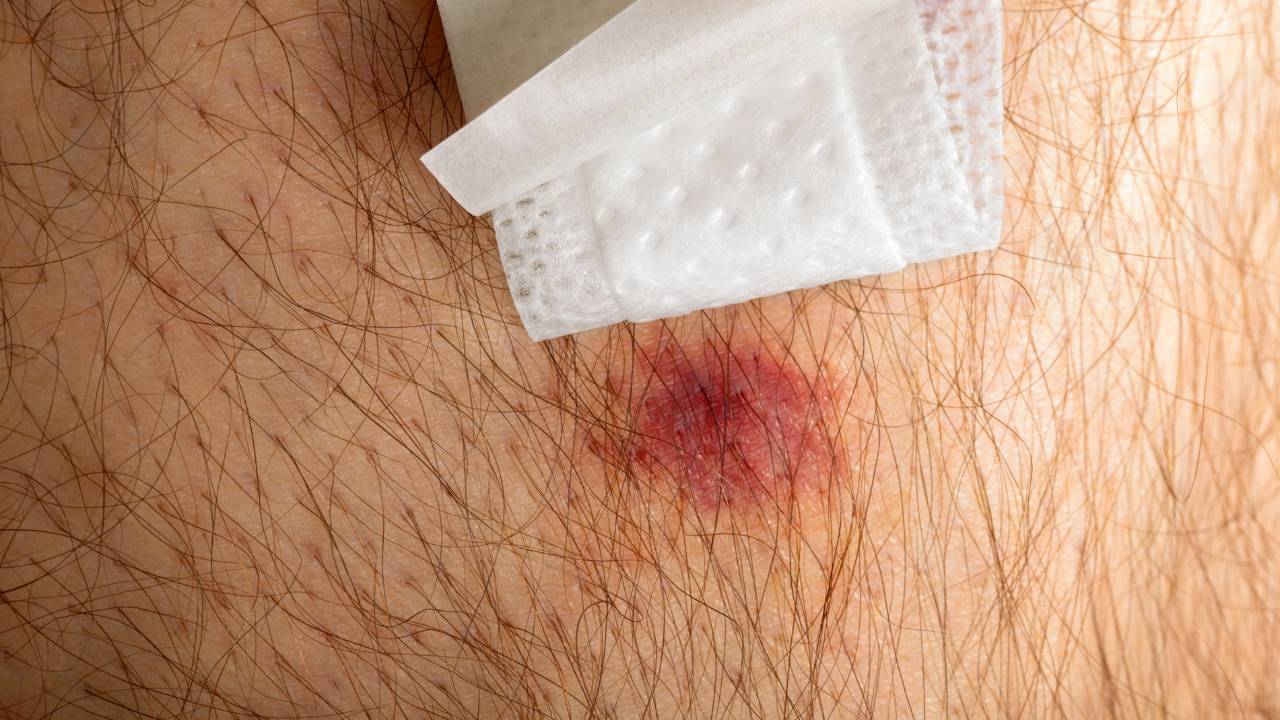 Kako prepoznati i liječiti ugriz pauka?