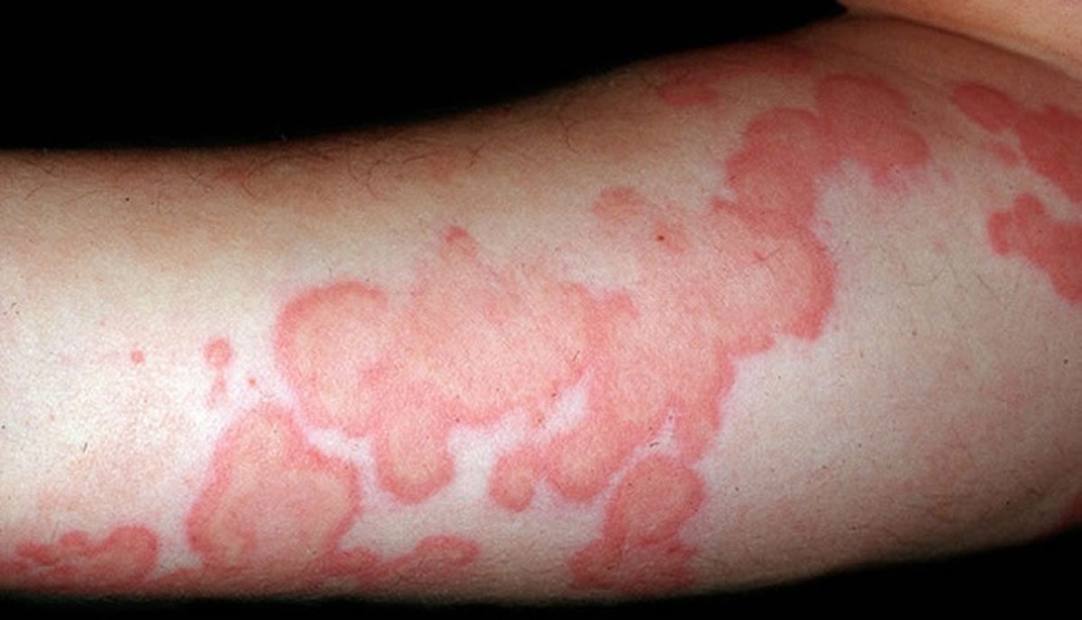 Koprivnjača prirodno liječenje - Čajna mješavina od dvije ljekovite biljke