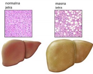 Masna jetra prirodno liječenje - Simptomi i čišćenje masne jetre