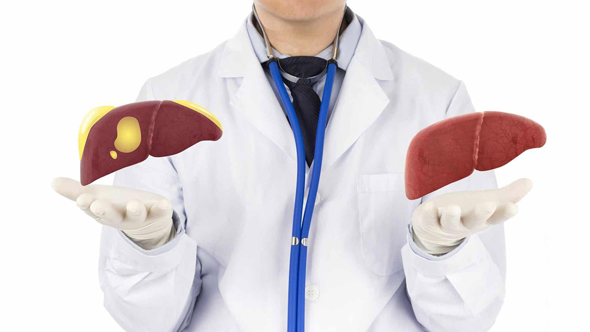 Da je masna jetra pokazuju ovi simptomi - Čišćenje masne jetre