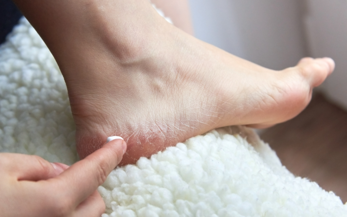 Zašto je njega stopala kod dijabetesa presudna - Ovo morate znati