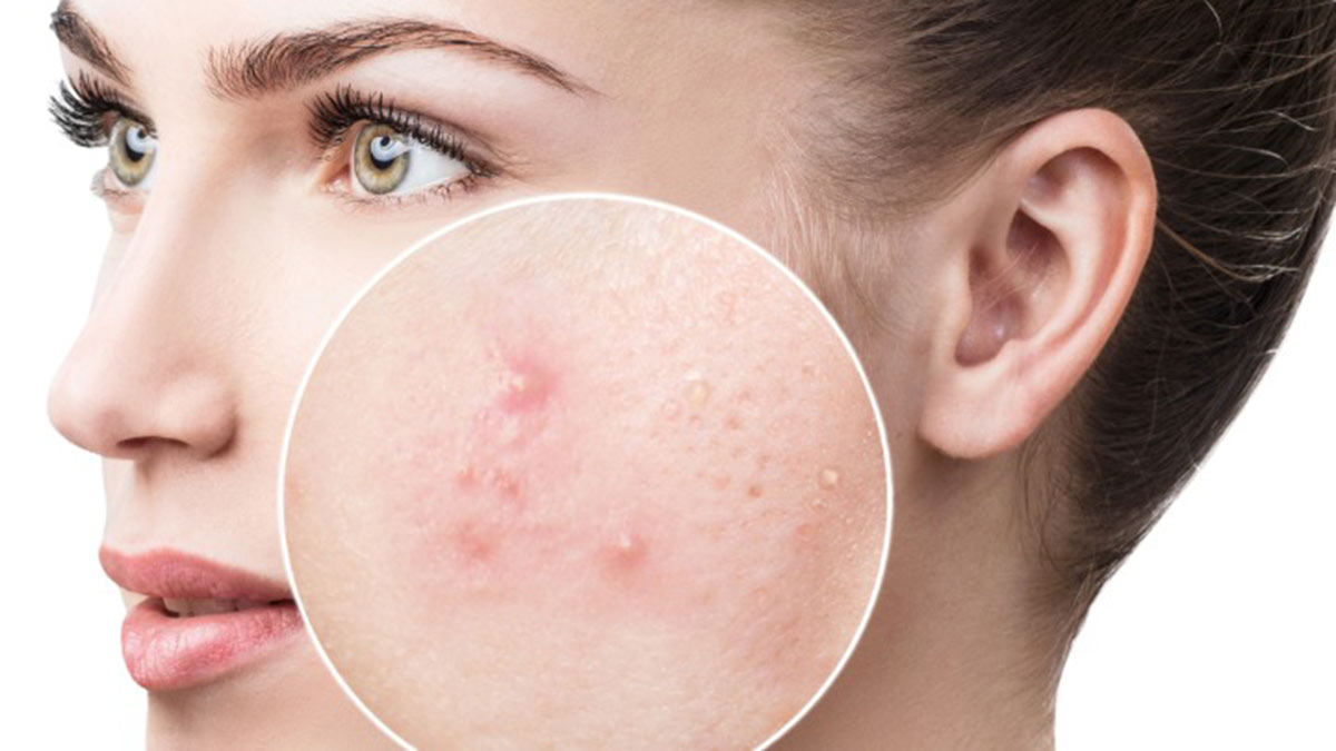 Prirodni lijek protiv akni - Uz ova dva sastojka akne nestaju za 1 dan