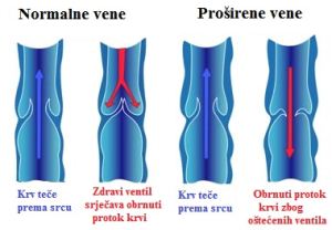 Proširene vene i hemoroidi