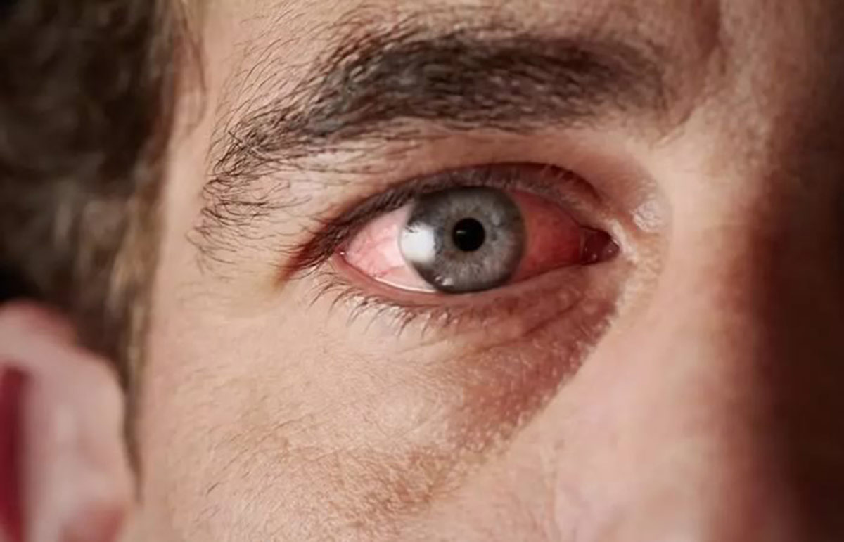 Sarkoidoza - Uzroci, simptomi i prirodno liječenje...