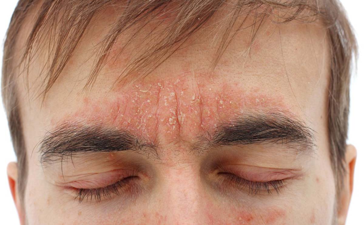 Seboroični dermatitis prirodni lijek - Maslinovo ulje za seboroični ...