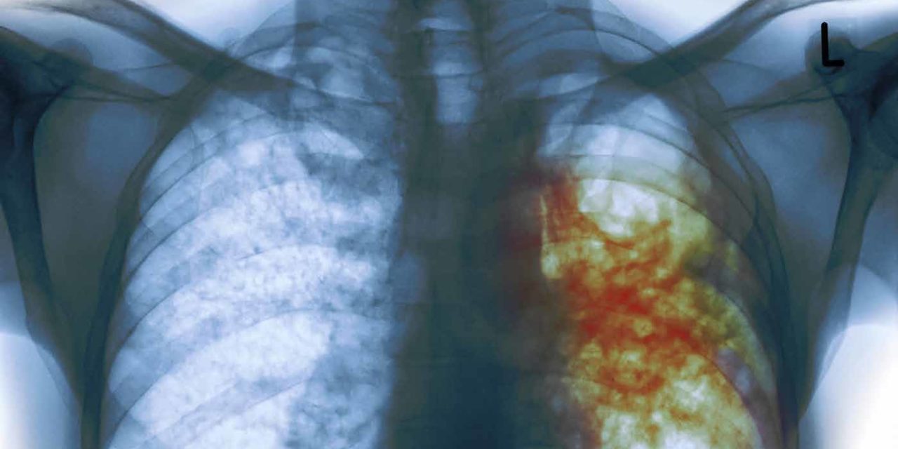 Tuberkuloza ili TBC- Simptomi, liječenje i prirodni lijek za tuberkulozu